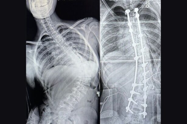 Corrective Spinal Surgery Transforms Life of Teen With Scoliosis and ...