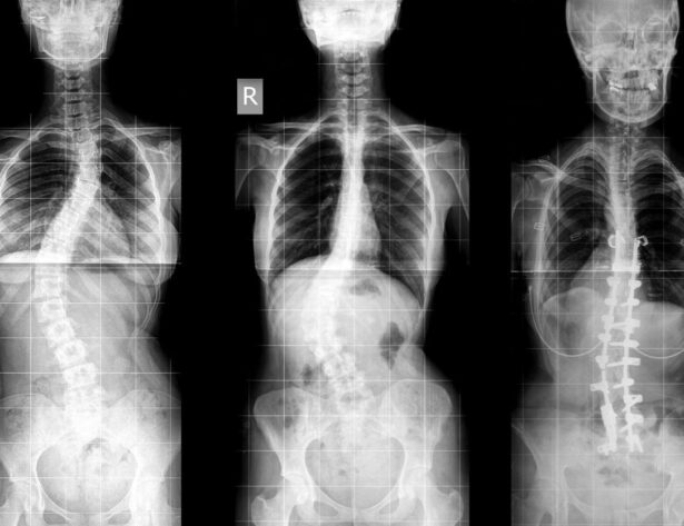 Harrington Rod vs. Growing Rod | Scoliosis Care